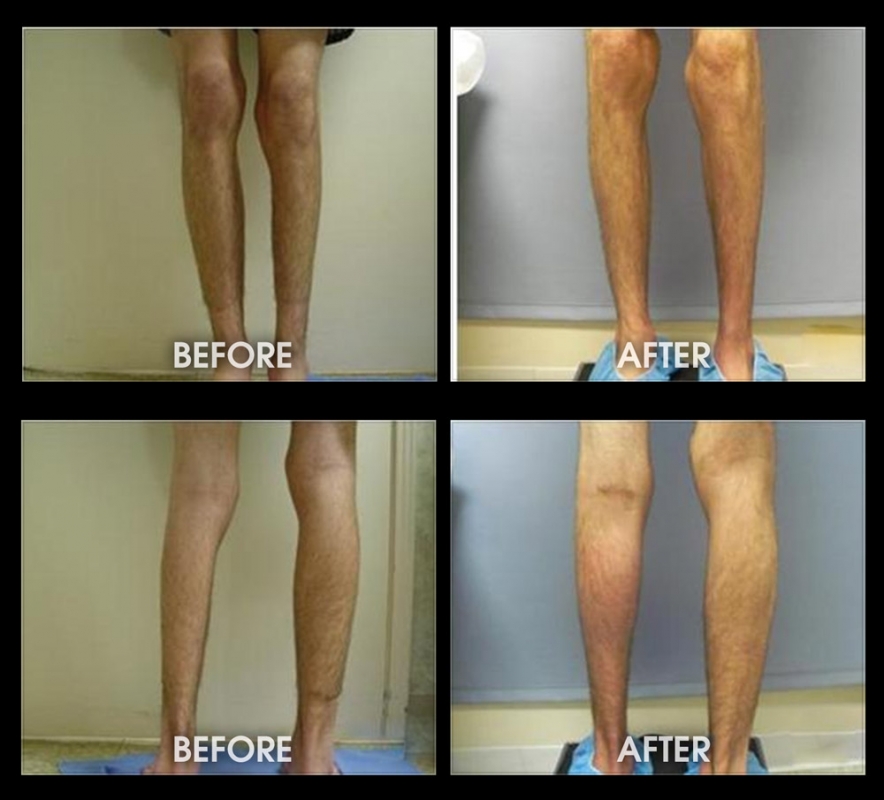 Male Calf Implants - Before and After Photos, Los Angeles