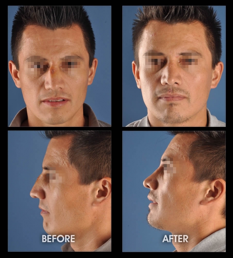Male Rhinoplasty - Before and After Photos, Los Angeles